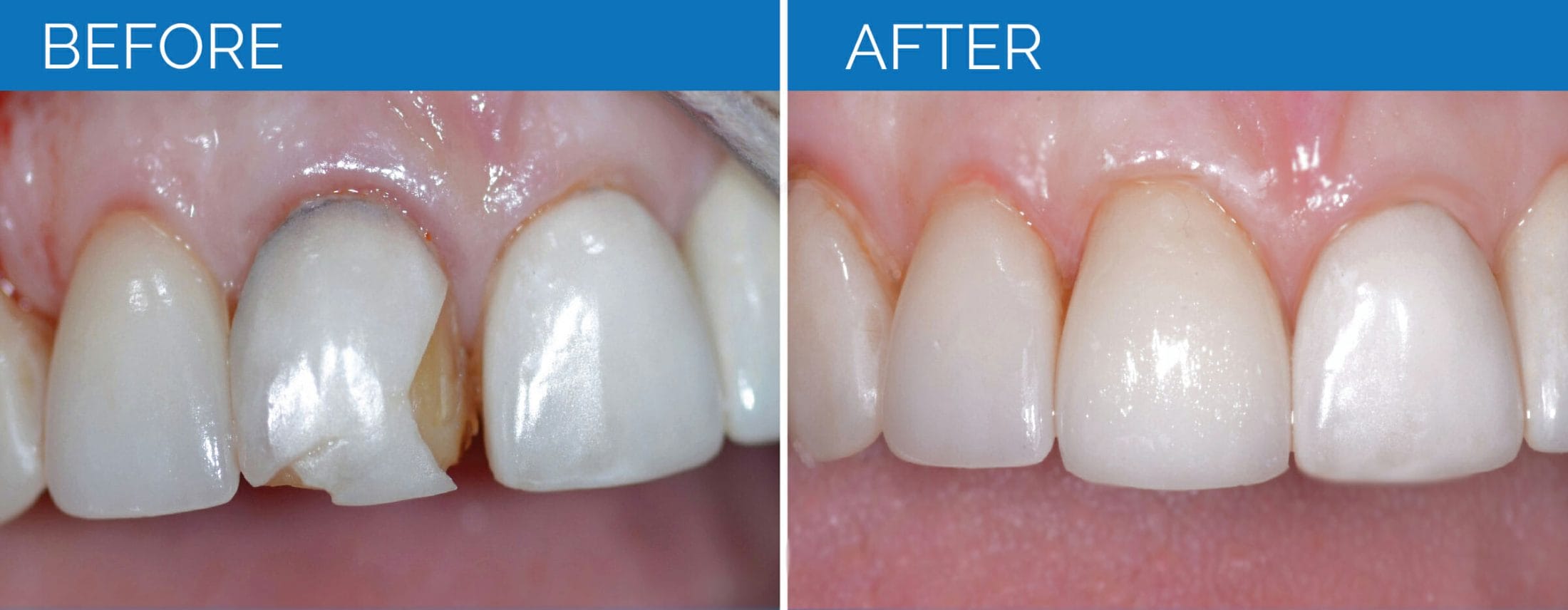 Tooth Decay Treatment Before And After
